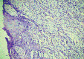 Spindle cell carcinoma of the head and neck region: treatment and ...