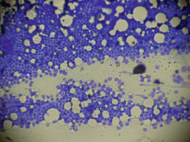 Successfully predicting bone marrow failure caused by drugs, radiation ...