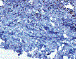 Erythrodermic mycosis fungoides with hypereosinophilic syndrome: a rare ...