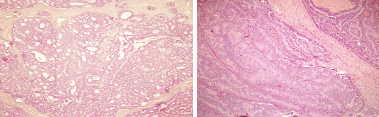 Synchronous bilateral breast cancer in a male - ecancer