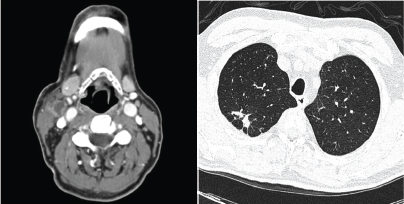 Lymph node tuberculosis after allogeneic haematopoietic stem cell ...